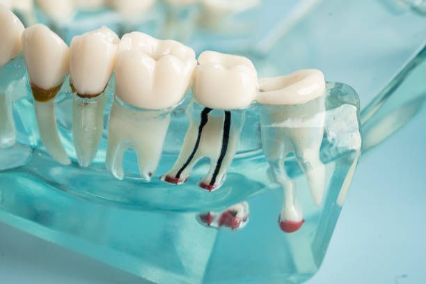 Endodonti (Kanal Tedavisi) – Viadent Ağız ve Diş Sağlığı Polikliniği